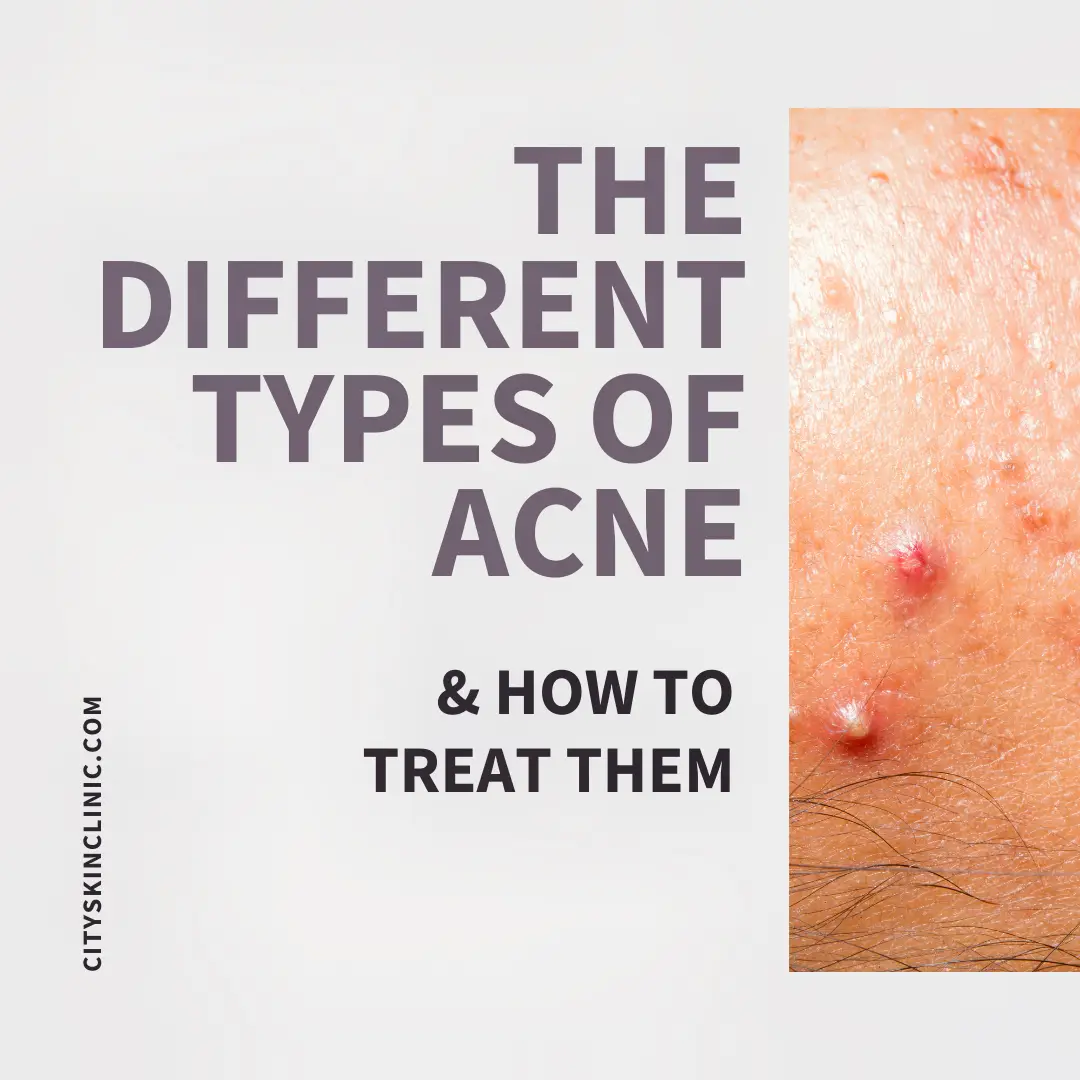 This is how to treat different types of acne 😊 | Gallery posted by Cityskinclinic | Lemon8