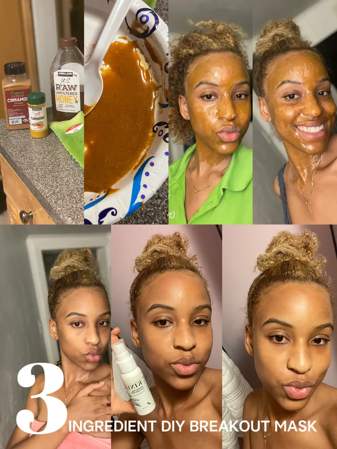 ARE YOU BREAKING OUT ? | Gallery posted by Zoee.rayne | Lemon8