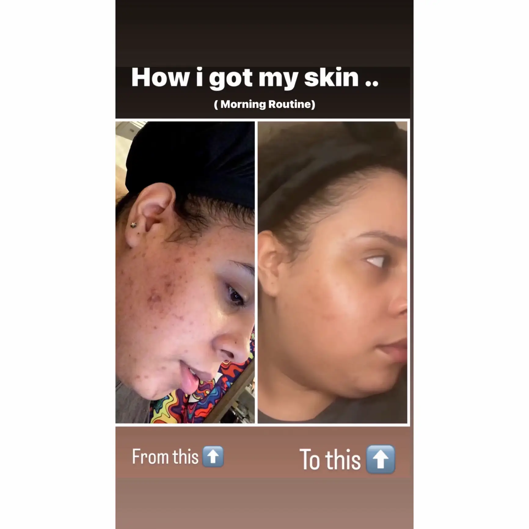 Hyperpigmentation help 😩 !!! | Gallery posted by Yami elis | Lemon8