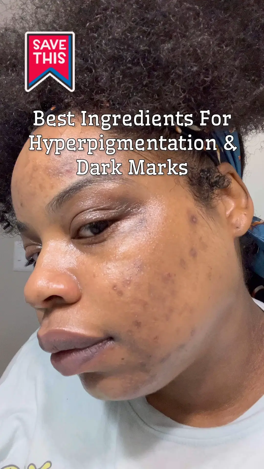 Ingredients for dark marks & hyperpigmentation | Video published by Jess | Lemon8