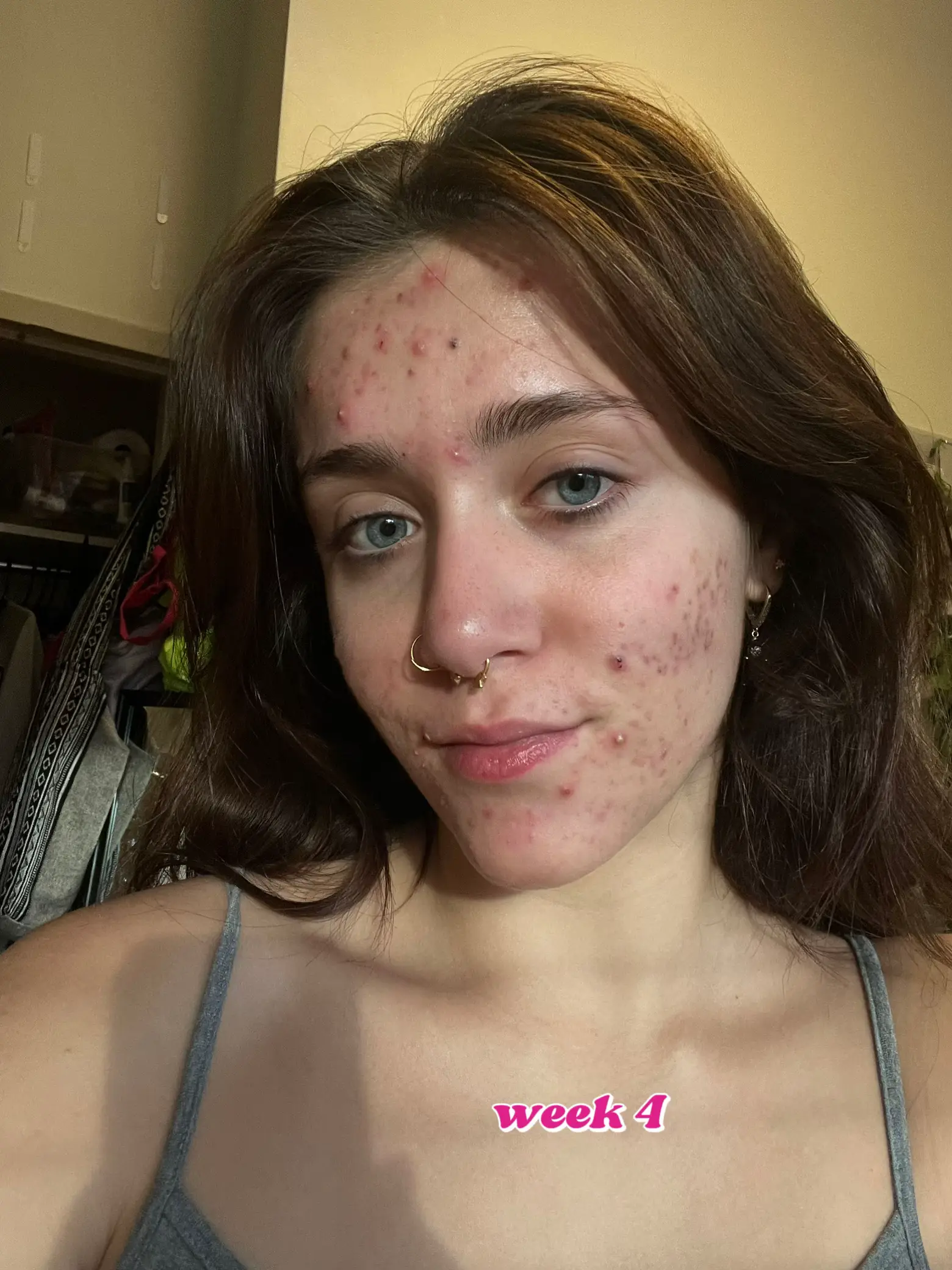 week 4 on accutane | Gallery posted by Octavia | Lemon8