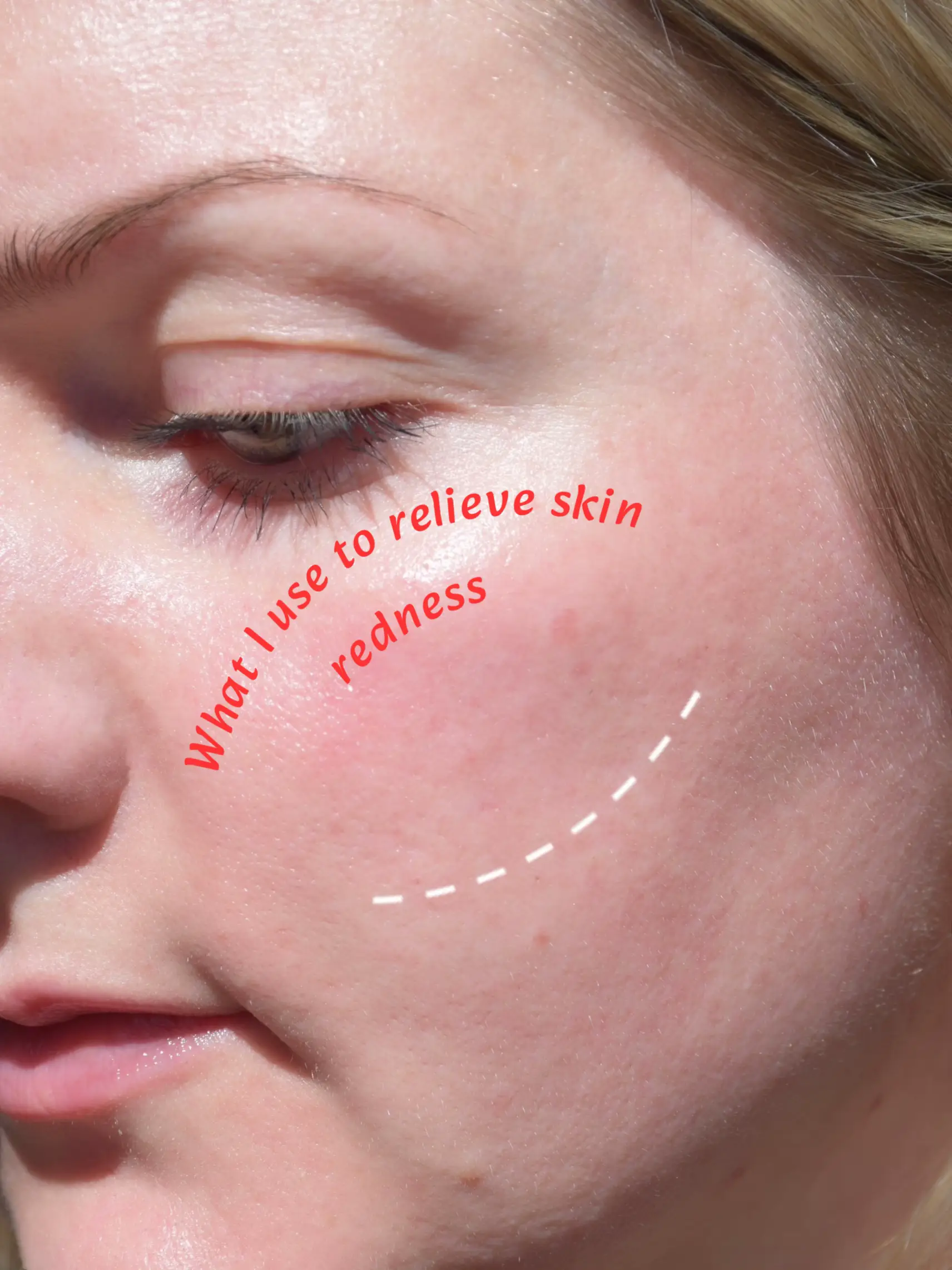 What I use to relieve skin redness ♨️ | Gallery posted by Ausra 🎀 | Lemon8