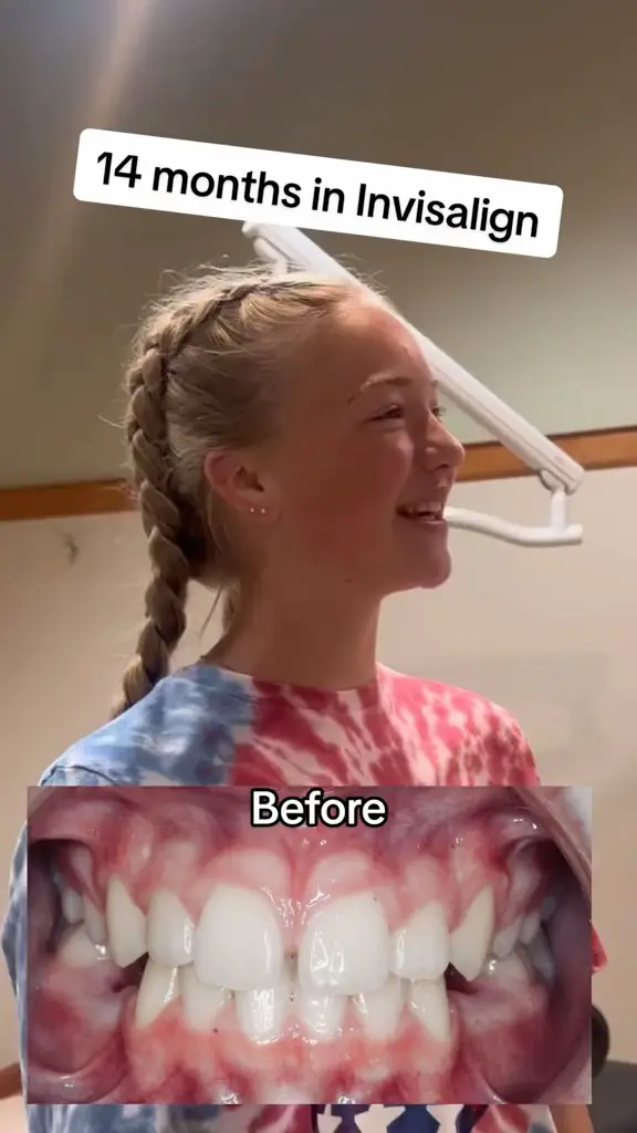 Invisalign Transformation | Video published by Choice Ortho | Lemon8