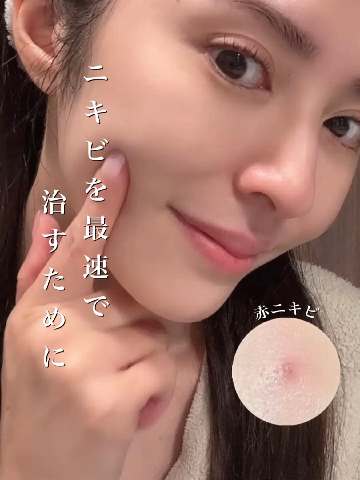 ニキビを最速で治したい人 | shiho💍オイリー女美容の投稿動画 | Lemon8