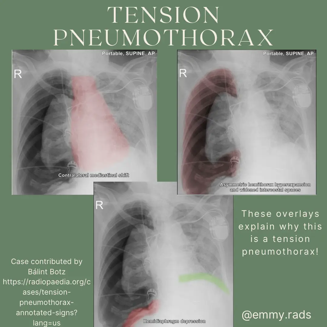 Tension Pneumothorax! 🚨🩻 | Gallery posted by Em Barnard, MD | Lemon8
