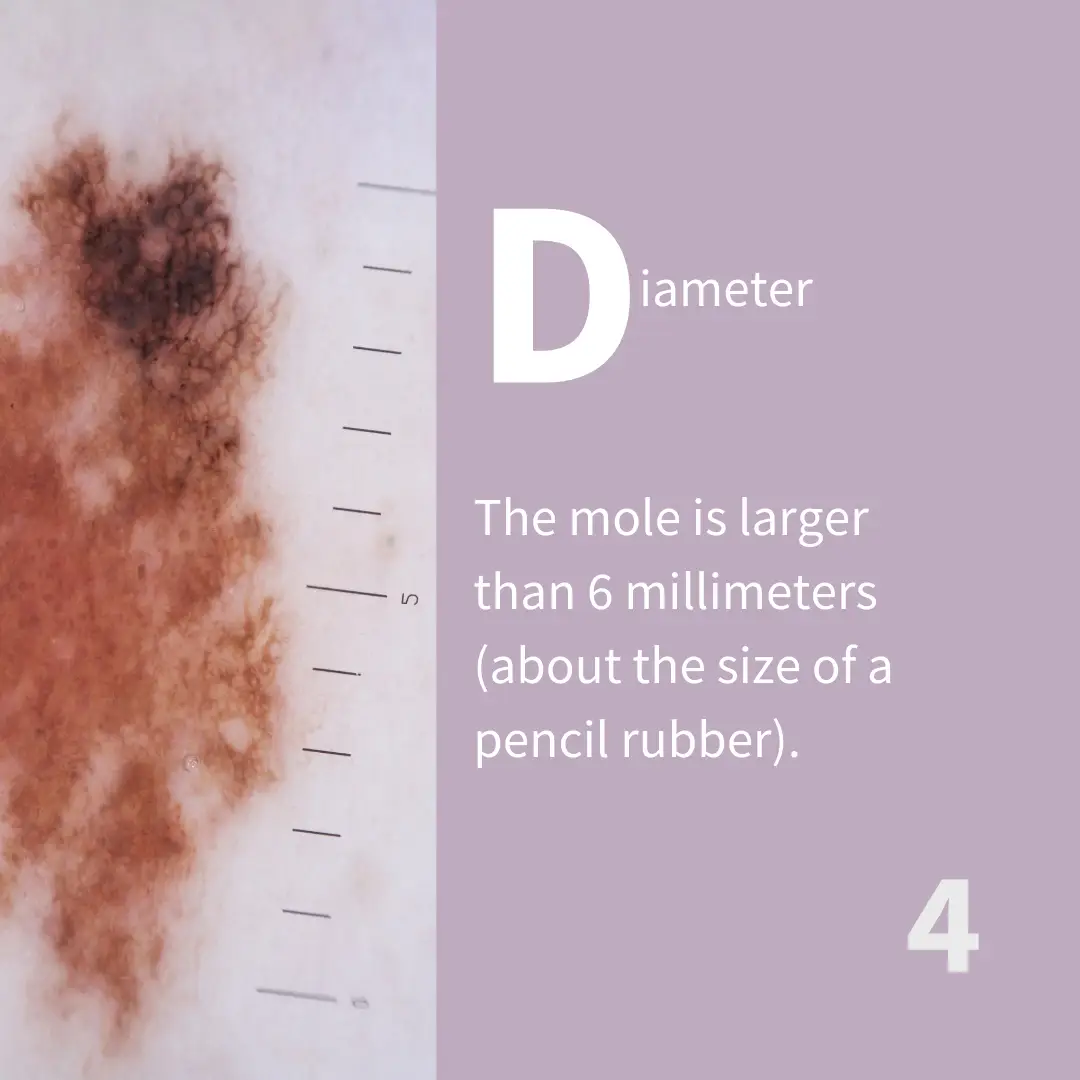 How to check for skin cancer 🫶 | Gallery posted by Cityskinclinic | Lemon8